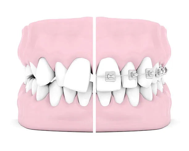 overjet braces