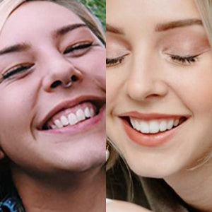 Invisible Braces from NewSmile™ - Straighten Teeth At Home